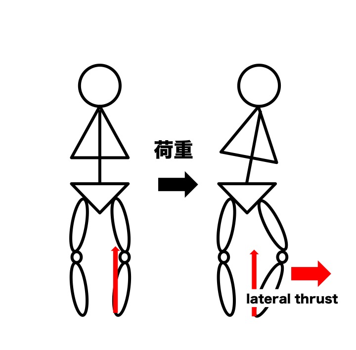 「lateral thrust（ラテラルスラスト）」とは？その病態やリハビリでの対策は？