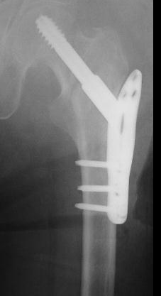 整形外科分野でよく聞く「ORIF」って何？どんな手術方法がある？