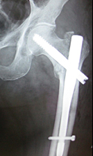 整形外科分野でよく聞く「ORIF」って何？どんな手術方法がある？